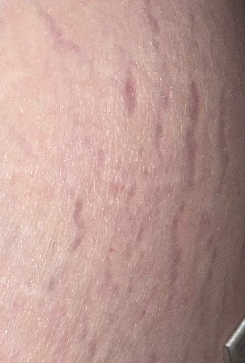 Bartonella Flair – PhilippiJoy